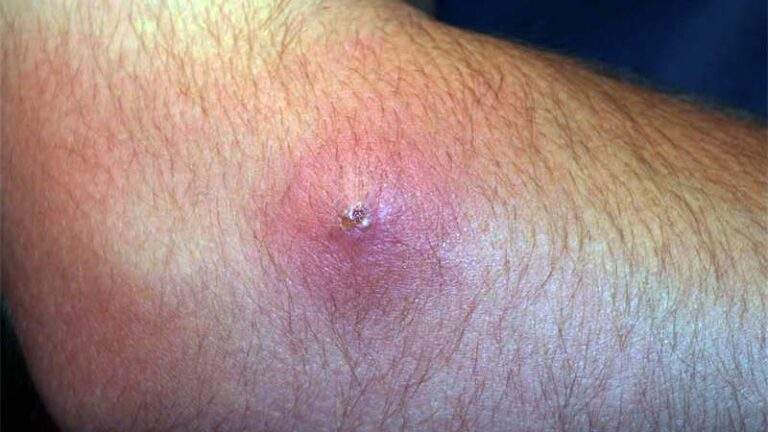 Il Ragno Violino: Caratteristiche, Pericoli e Come Proteggersi